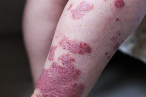 What Are The Signs And Symptoms Of Psoriatic Arthritis
